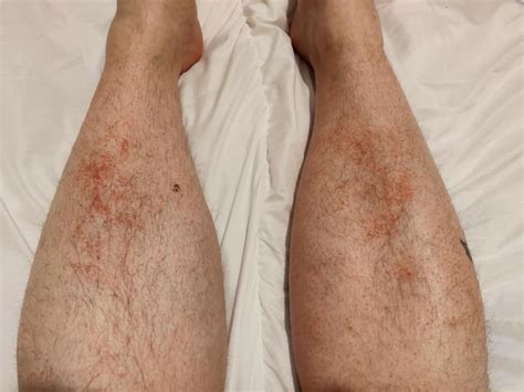 Itchy Hot Rash On Both Shins R Dermatologyquestions