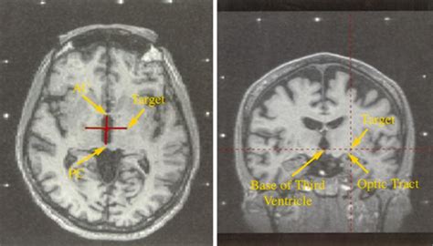 Anterior Commissure Mri