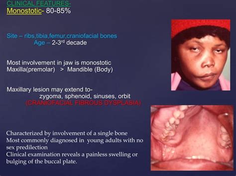 Fibro Osseous Lesions Pptx Dental Health Diseases And Conditions