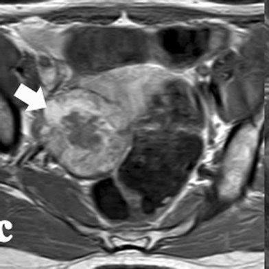 Case CT01 Axial Plain CT Scan A Showing A Round And Well Defined Download Scientific Diagram