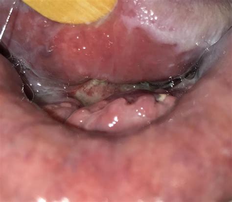 Dradulce Helena Cabelho Passarelli On Linkedin Eritroleucoplasia