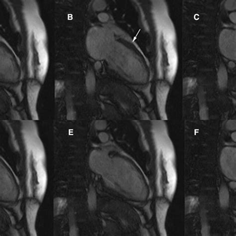 Example Of Pvc Site Of Origin Determined By 3d Electroanatomic Mapping