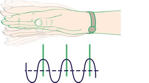 Essential Tremor Amplitude Modulation By Median Nerve Stimulation