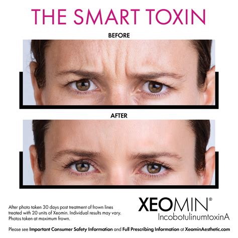Xeomin Chicago Skin Clinic