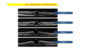 Cscr Central Serous Chorioretinopathy PPTX Eye And Vision Conditions Diseases And