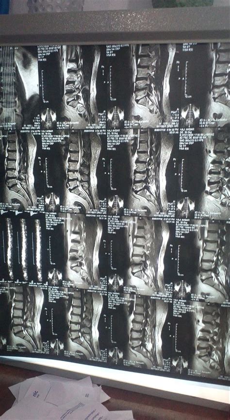 Dr Abdur Rahim On Linkedin L4 And L5 Stenosis Pt Having Neurogenic