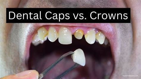 Dental Caps Vs Crowns A Comprehensive Guide To Making The Right Choice