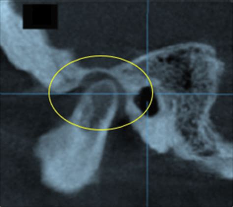 Three Dimensional Evaluation Of Condylar Position In Skeletal Class I And Class Ii Malocclusions