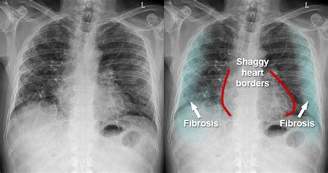 What Does Lung Scarring Look Like On Ct Scan Ct Scan Machine