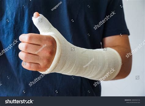 Broken Hand Cast