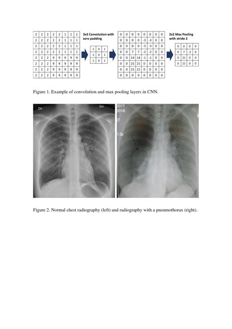 Automated Diagnosis Of Pneumothorax Using An Ensemble Of Convolutional Neural Networks With