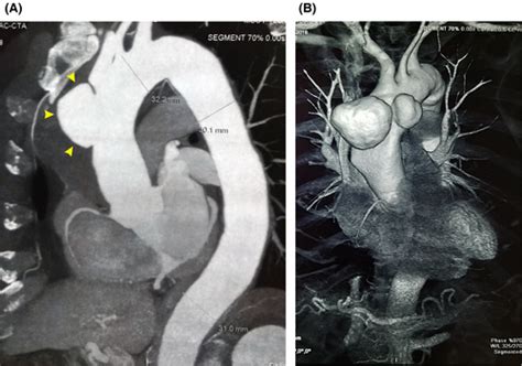 Dissected Saccular Aneurysms Of The Ascending Aorta Aljasem 2019
