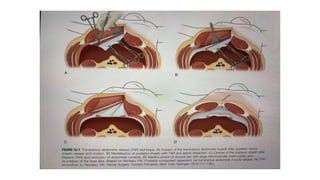 Umbilical Hernia A Comprehensive Presentation On Various Surgical