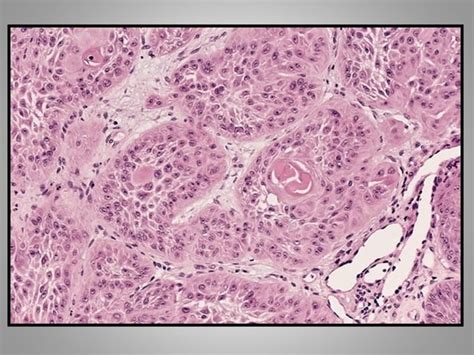 4 Neoplasiappt For Health Science Students Ppt
