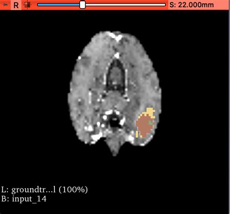 GitHub Erenarkangil Brain Tumor Segmentation Our Approach For Brats Challange By Using