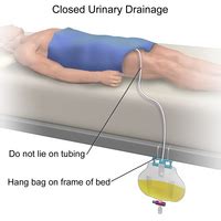 Urinary Catheterization Wikipedia