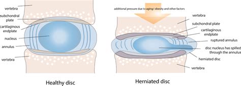 Disc Herniation Rajiv Bajekal
