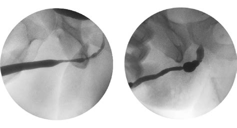 Examples Of Retrograde Urethrograms Where Length And Characteristics Of Download Scientific