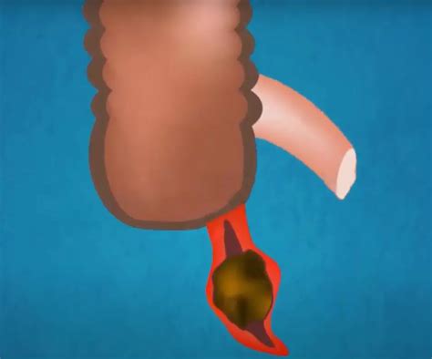 Appendix Stones Appendicolith Incidence Causes Symptoms And Treatment Oh My Gut