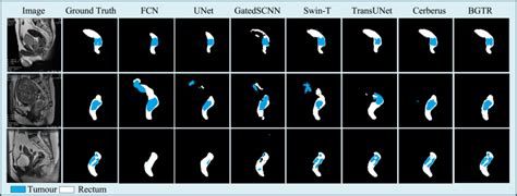 A Boundary Guided Transformer For Measuring Distance From Rectal Tumor