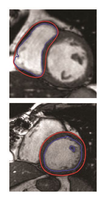 Segmentation Endocardial And Epicardial Contours Using Proposed Method Download Scientific