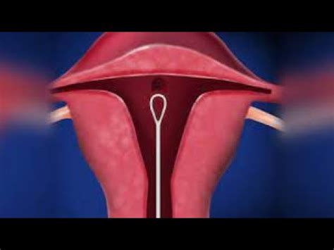 Dilation And Curettage CPT Code Simplify Medical Coding YouTube