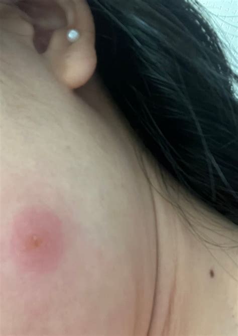 점 제거 후 듀오덤 알러지 접촉성 피부염 네이버 블로그