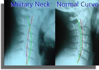 Military Neck What Is It Should It Be Corrected And How To Fix It