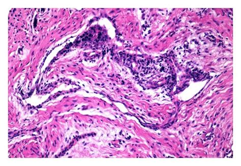A Ameloblastic Epithelium In The Fibroblastic Stroma Hande ×20 B