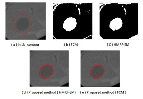 Segmentation Results Of A Computed Tomography Image Download