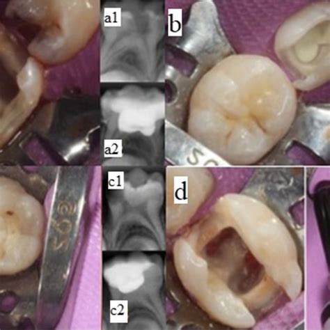 Pre Operative Radiograph For Formocresol Pulpotomy Group B Download Scientific Diagram