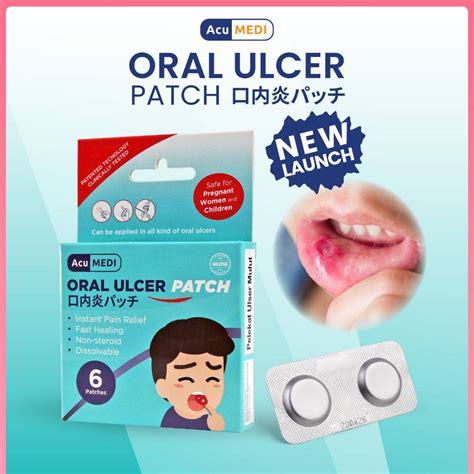 Mouth Ulcer Patch Pelekat Ulcer Mulut Acumedi Oral Ulcer Patch For