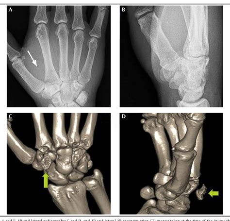 Avulsion Fracture Hand
