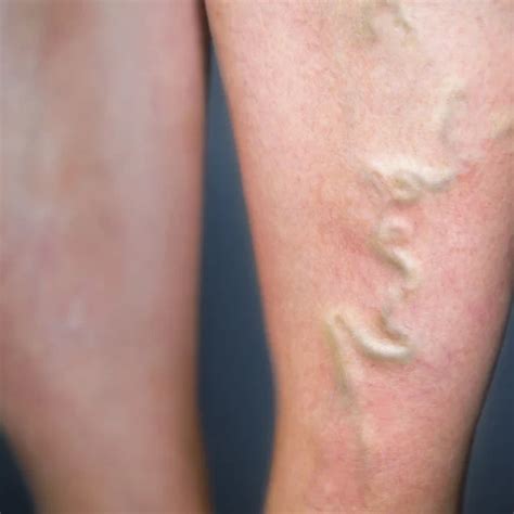 Phlebitis In Lima Celina Ohio Vein Care Center