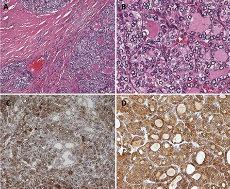 A Neoplastic Cells Are Arranged In A Follicular Pattern Of Growth Download Scientific Diagram