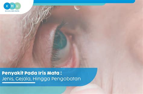 Penyakit Pada Iris Mata Jenis Gejala Hingga Pengobatan