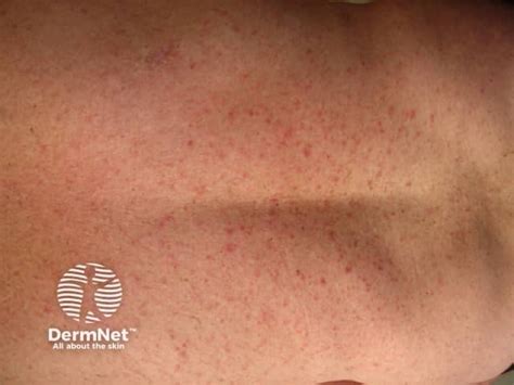 Grover Disease Transient Acantholytic Dermatosis Dermnet