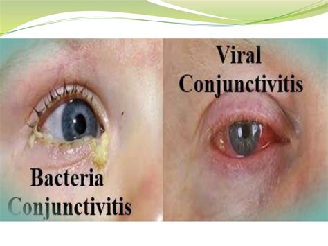 Conjunctivitis Pdf
