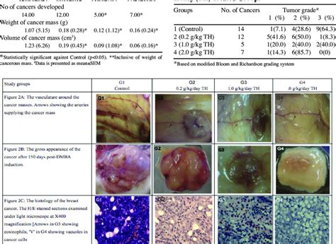 Invasive Ductal Carcinoma Gross Invasive Ductal Carcinoma Gross