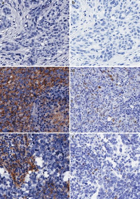 Pd L1 Expression And Cd274 Gene Alteration In Triple Negative Breast Cancer Implication For