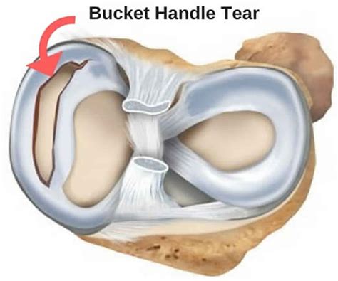 Bucket Handle Tear Of Medial Meniscus Surgery My Projects