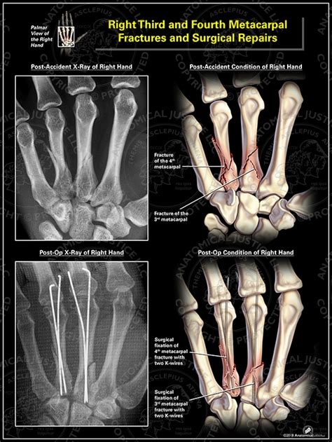Right Third And Fourth Metacarpal Fractures And Surgical Repairs
