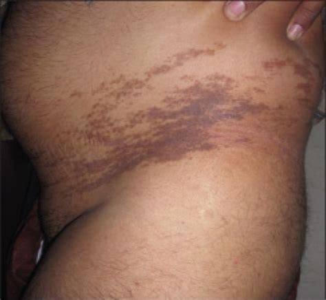 Progressive Cribriform And Zosteriform Hyperpigmentation Where Are We