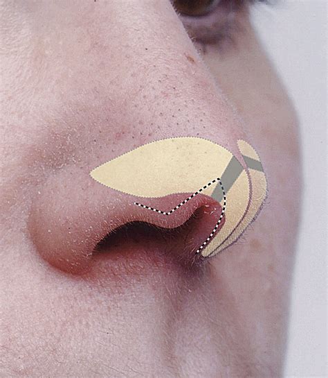 Repair Of Nasal Soft Triangle Notching Journal Of Plastic Reconstructive And Aesthetic Surgery