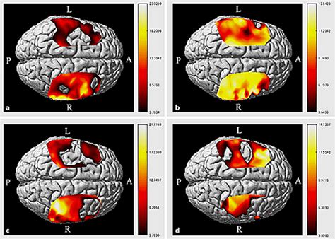 Low Frequency Rtms And Intensive Occupational Therapy Improve Upper Limb Motor Function And