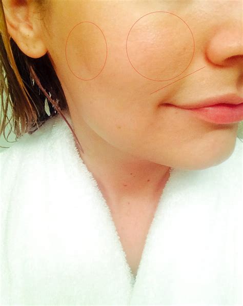 Melasma Treatment PS Beauty