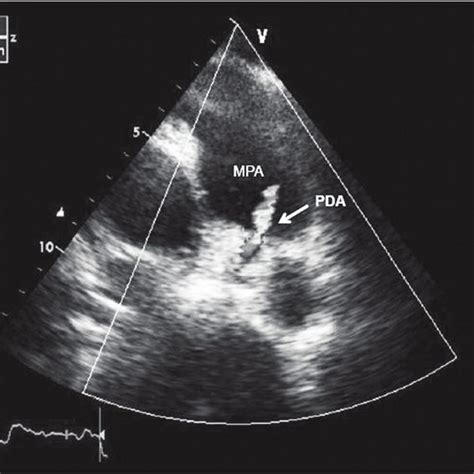 Colour Flow Doppler Across The Pda Demonstrating The Presence Of A