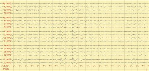 Electroencephalogram Revealing Epileptiform Discharges In The Left