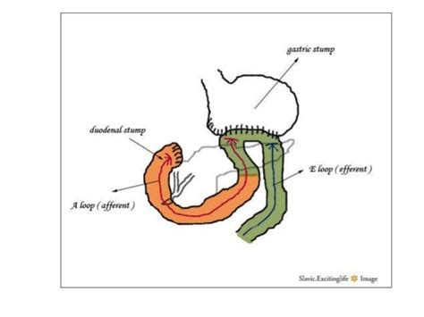 Efferent Loop Syndrom Med Kom