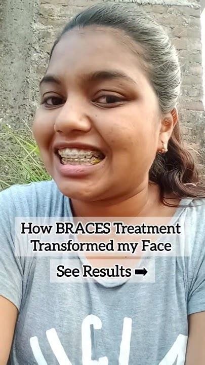 How Braces Treatment Transformed My Face Shorts Shortvideo Braces